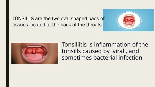 TONSILITIS Definition , types , causes , pathophysiology , riskfactors ...