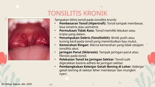 TONSILITIS KRONIK EKSASERBASI LAPORAN KASUS | PPTX