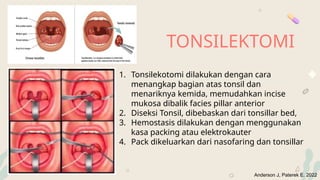 TONSILITIS KRONIK EKSASERBASI LAPORAN KASUS | PPTX