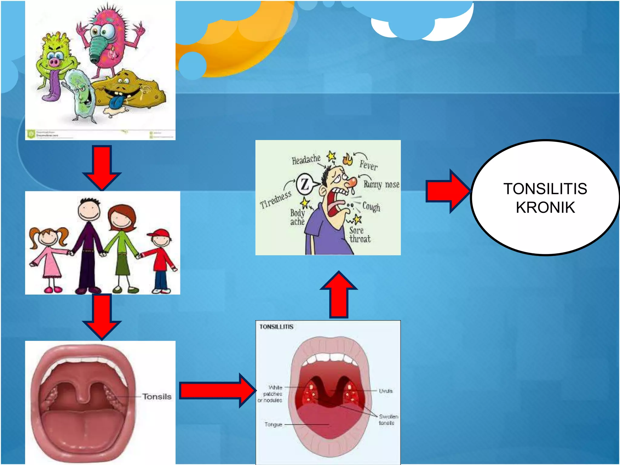 Tonsilitis kronis | PPTX
