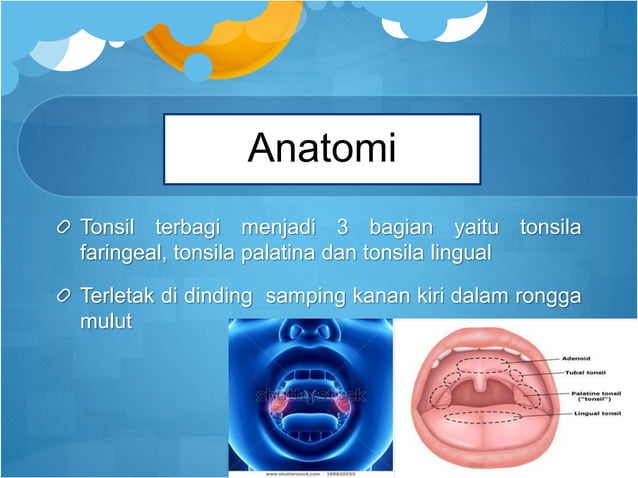 Tonsilitis kronis | PPTX