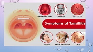 TONSILITIS MWANAMISI.POWER POINT PRESENTATION | PPTX