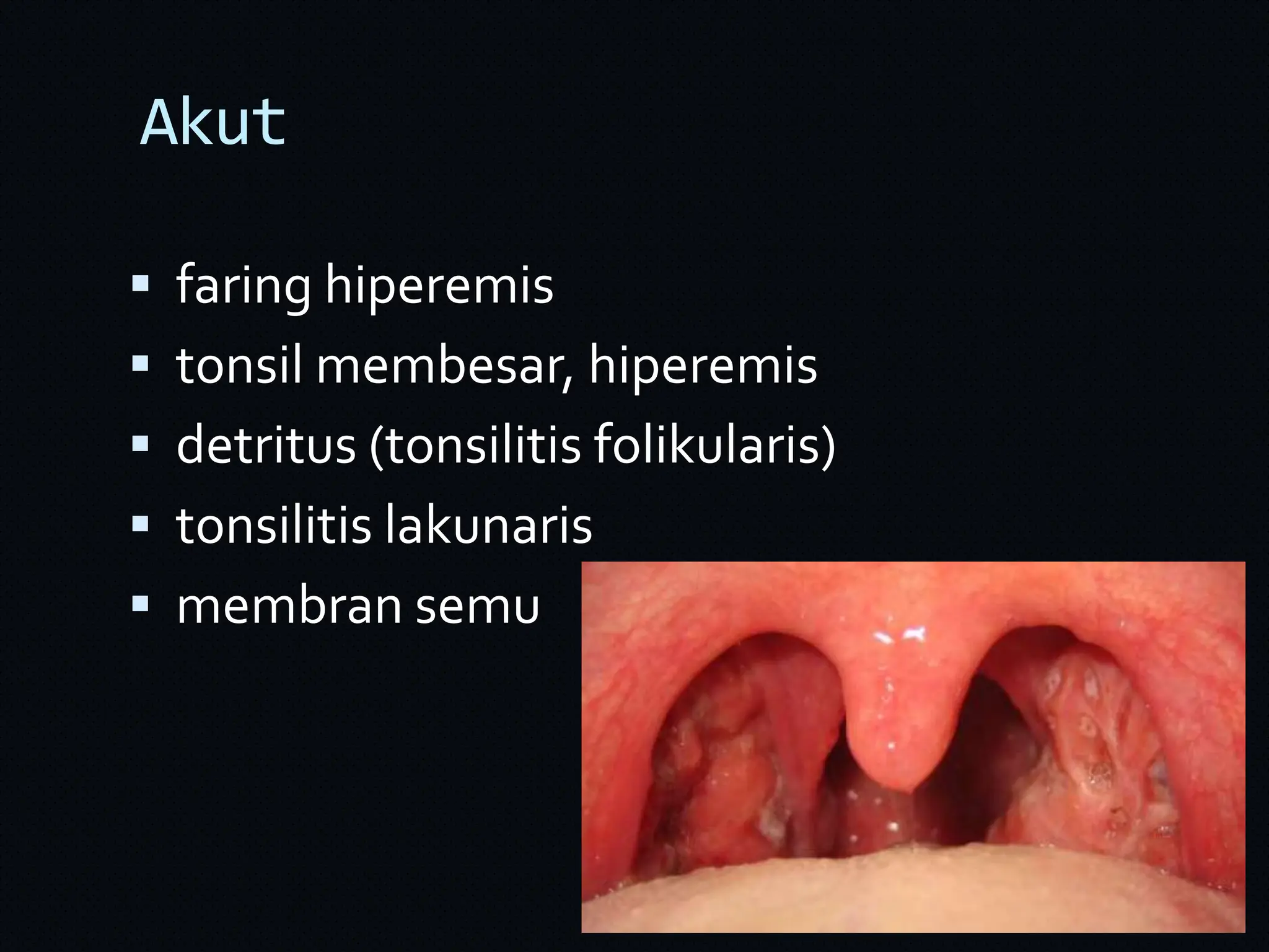 Tonsilitis pada Anak (Kapan harus operasi) - dr. Muslim Sp.THT-KL.pptx