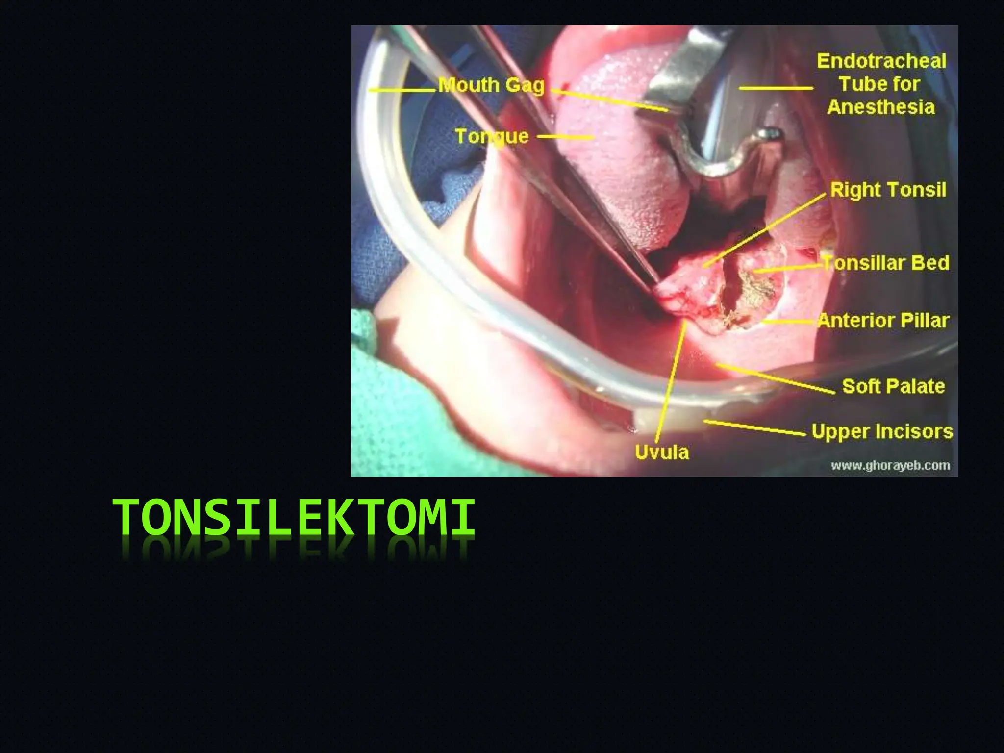 Tonsilitis pada Anak (Kapan harus operasi) - dr. Muslim Sp.THT-KL.pptx