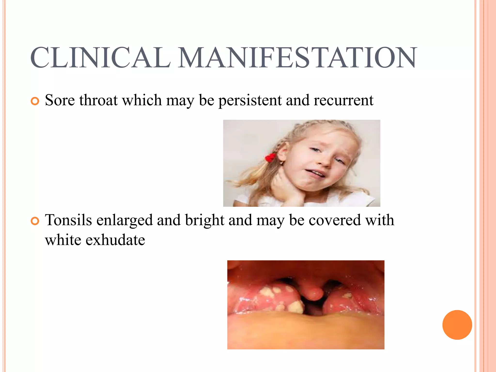 Tonsilitis ppt 1 | PPTX