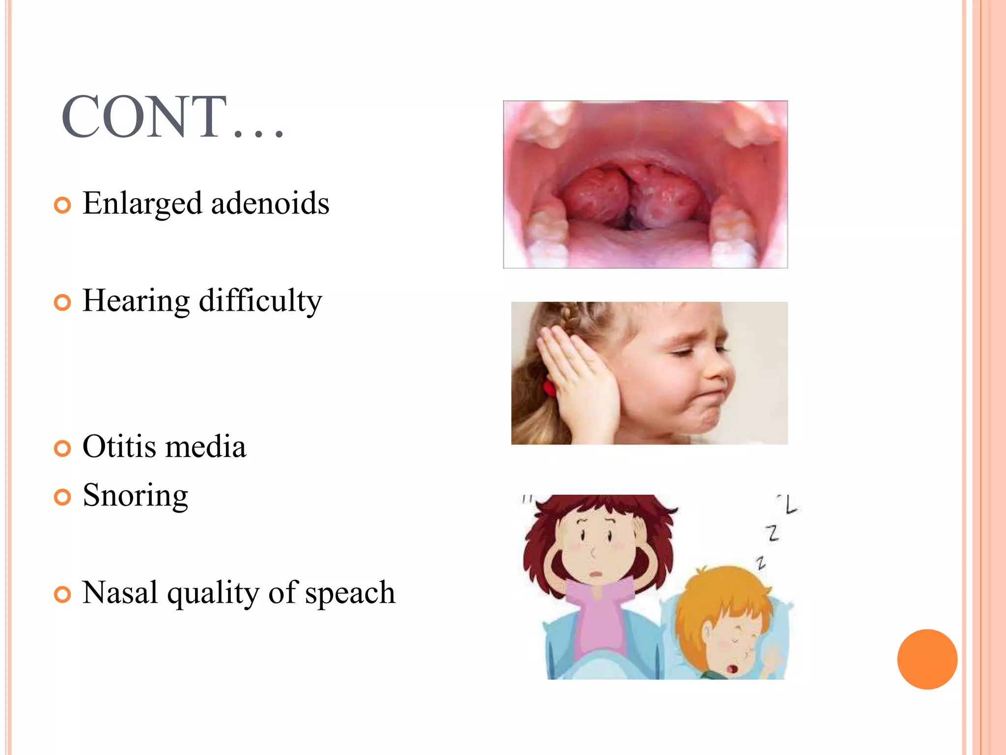 Tonsilitis ppt 1 | PPTX
