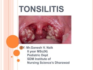 Tonsilitis ppt 1 | PPTX
