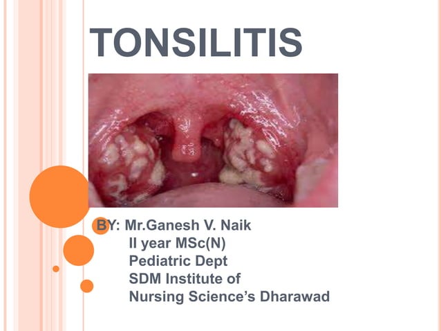 Tonsilitis ppt 1 | PPTX