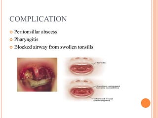Tonsilitis ppt 1 | PPTX