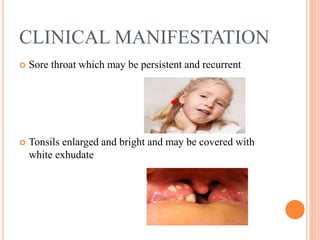 Tonsilitis ppt 1 | PPTX