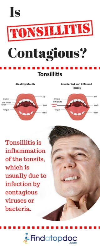 Is Tonsillitis Contagious? | PDF