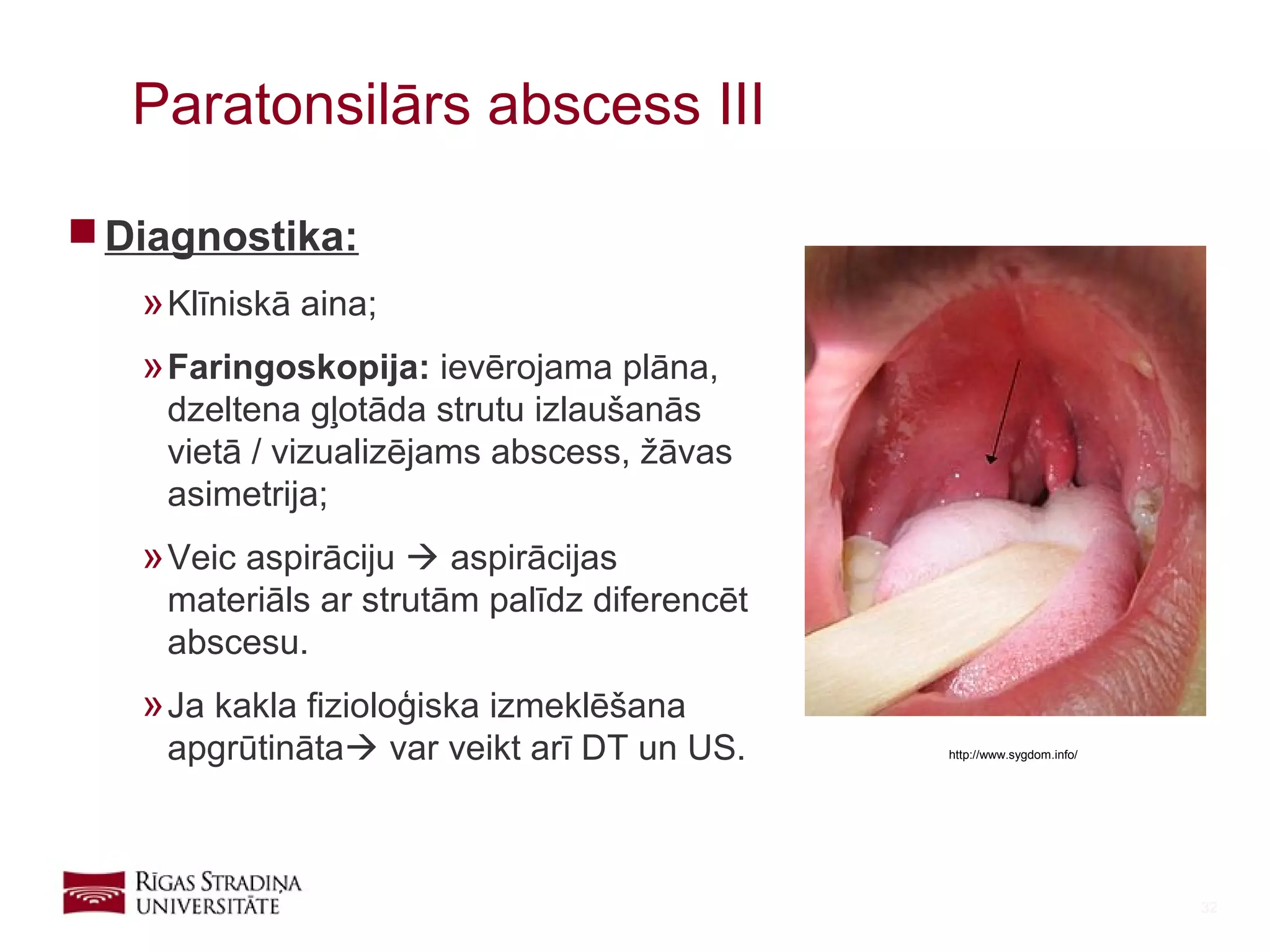 Akūta tonsilīta klīniskā norise un komplikācijas | PPT