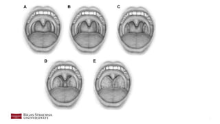 EBV connection to adenotonsillar hypetrophy | PPTX