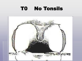 tonsillar size.ppt