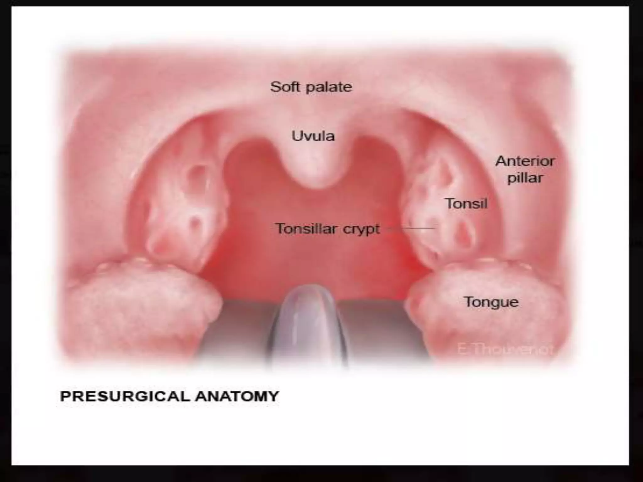 Tonsillectomy ENT for undergrad | PPTX
