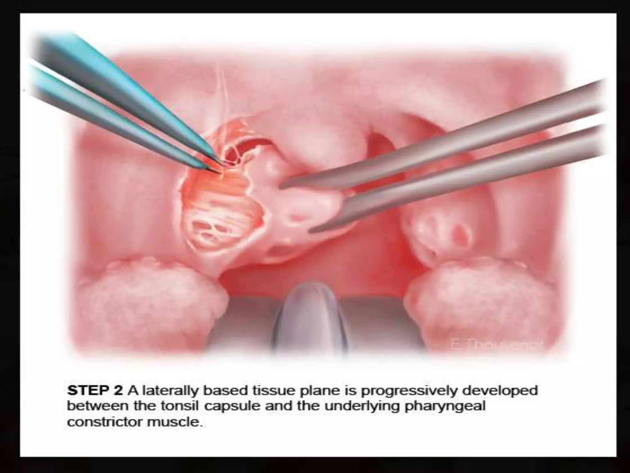 Tonsillectomy ENT for undergrad | PPTX