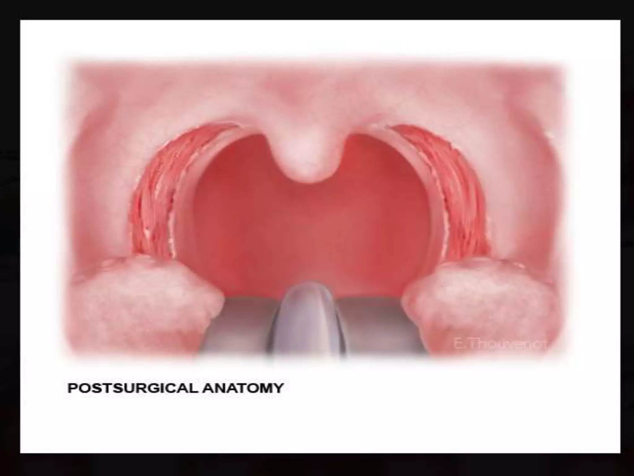 Tonsillectomy ENT for undergrad | PPTX