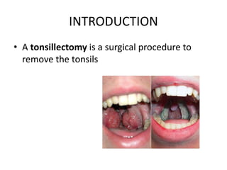 Tonsillectomy ENT for undergrad | PPTX