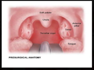 Tonsillectomy Anatomy
