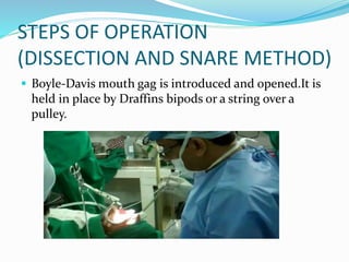 Tonsillectomy | PPTX