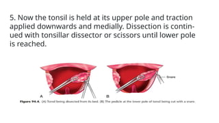Tonsillectomy and Adenoidectomy - Procedure .pptx