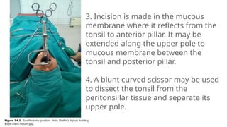 Tonsillectomy and Adenoidectomy - Procedure .pptx