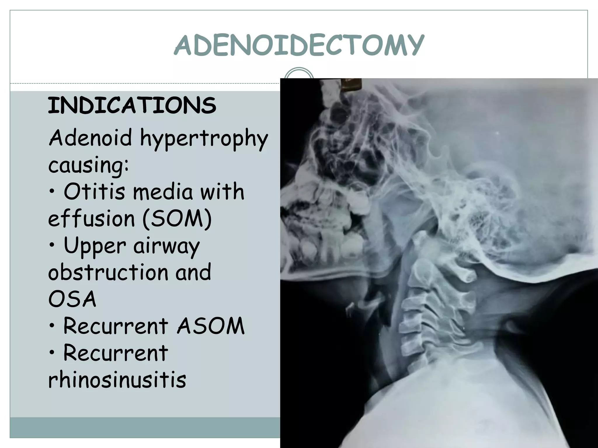 Tonsillectomy & adenoidectomy ashly | PPTX