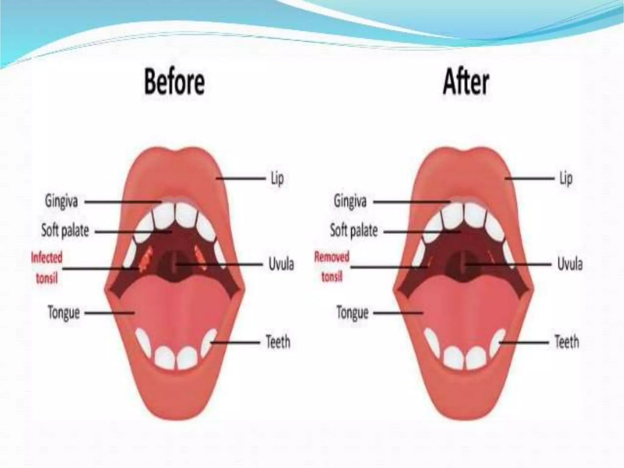 Tonsillectomy Ppt Pptx