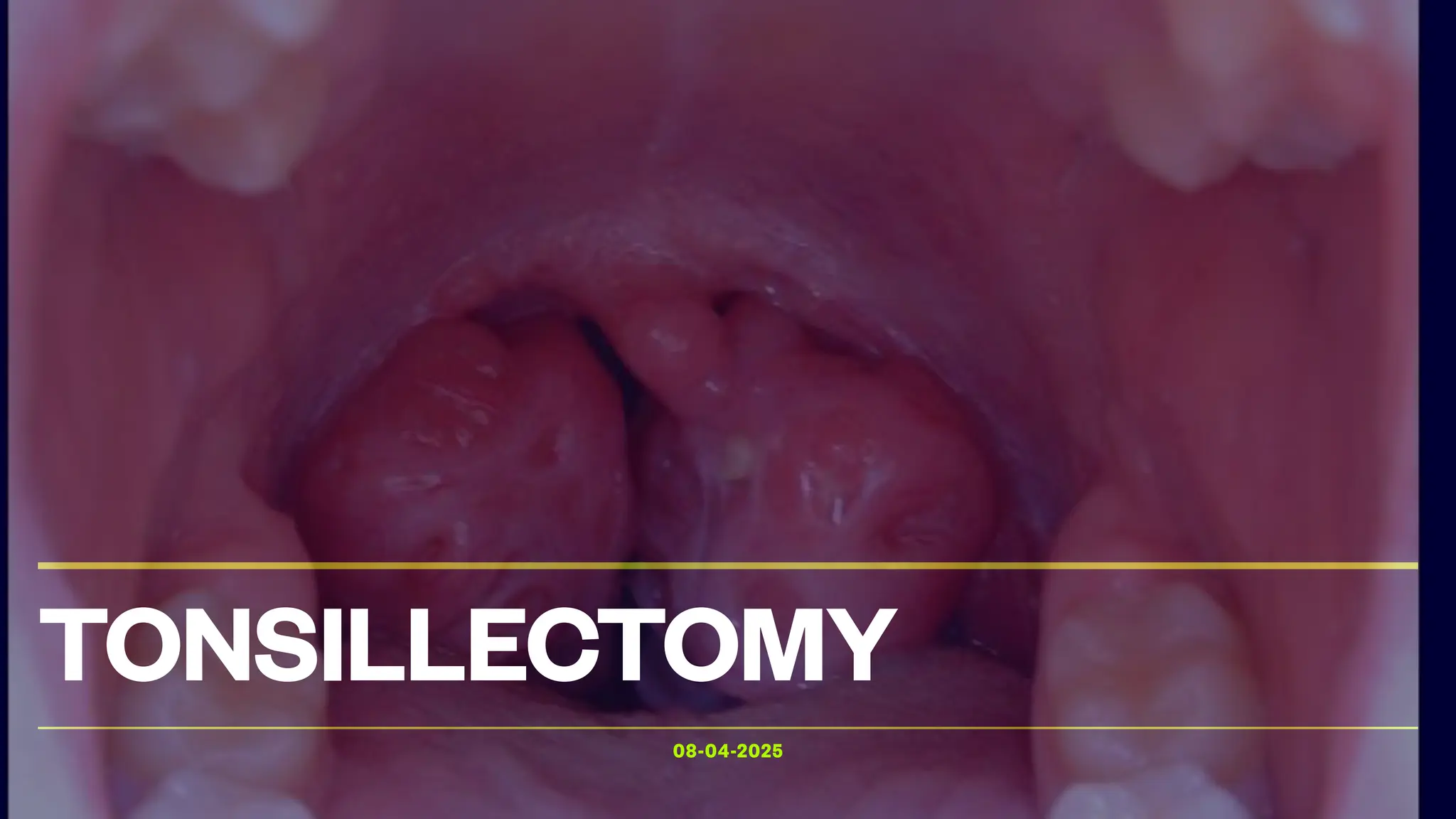 Tonsillectomy: Surgical Removal of Tonsils | PPT