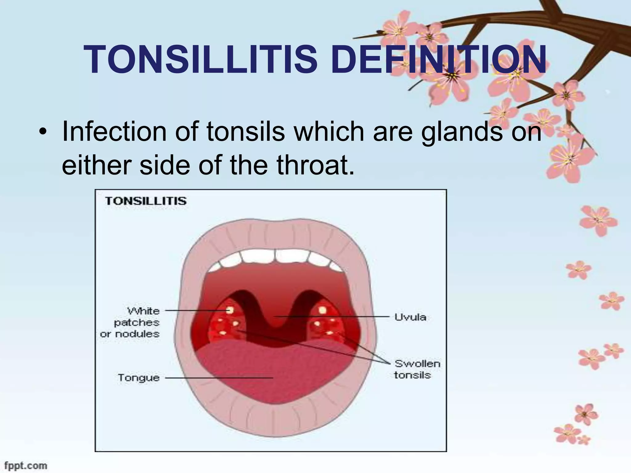 Tonsillitis.in children | PPTX