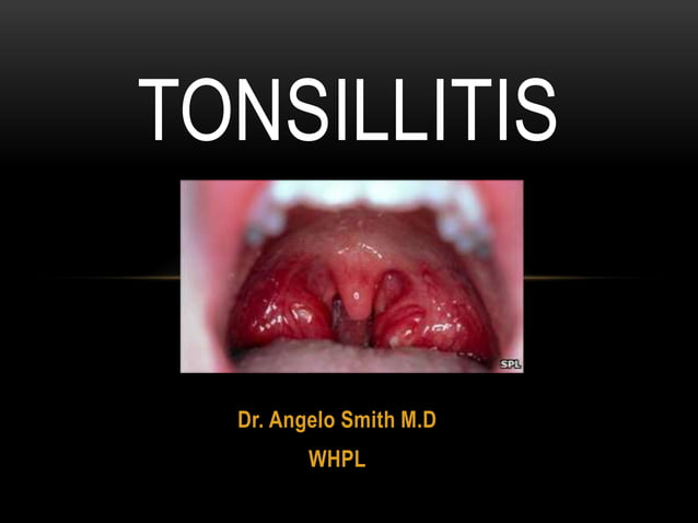 Tonsillitis | PPTX | Ear, Nose and Throat Conditions | Diseases and Conditions