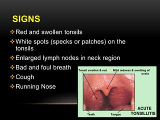 Tonsillitis | PPTX