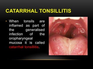 Tonsillitis | PPTX
