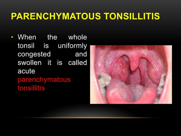Tonsillitis | PPTX | Ear, Nose and Throat Conditions | Diseases and ...
