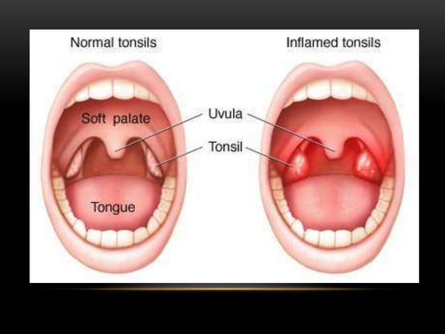 Tonsillitis | PPTX | Ear, Nose and Throat Conditions | Diseases and Conditions