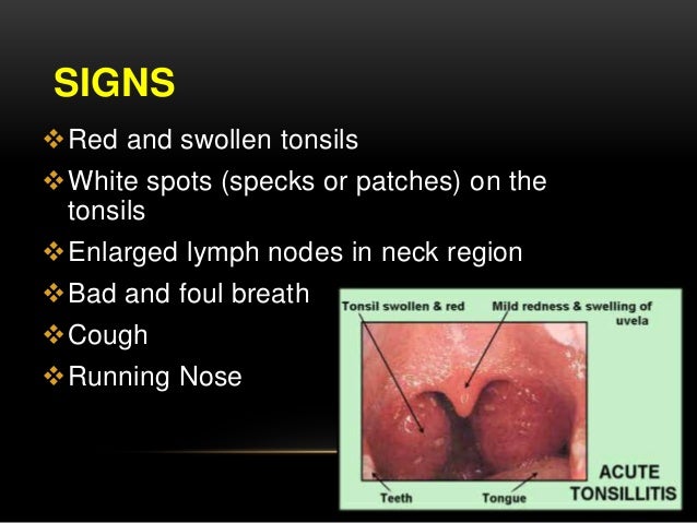Tonsillitis