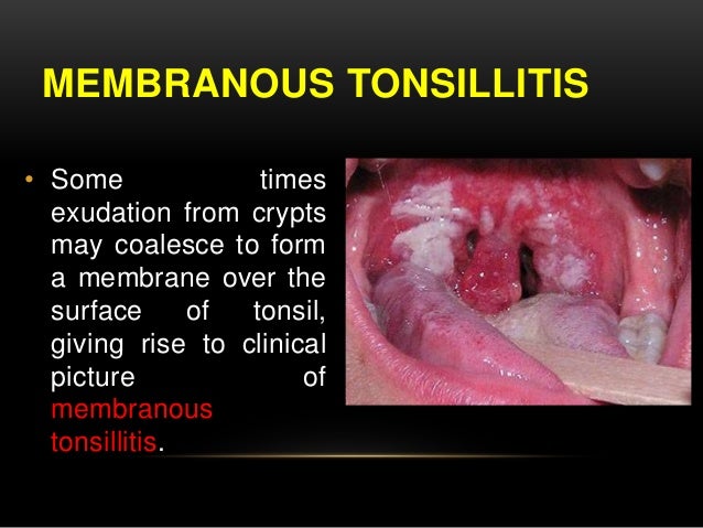 Bacterial Laryngitis Nhs White Tonsil Cyst V Alert Vrtl T Tonsil