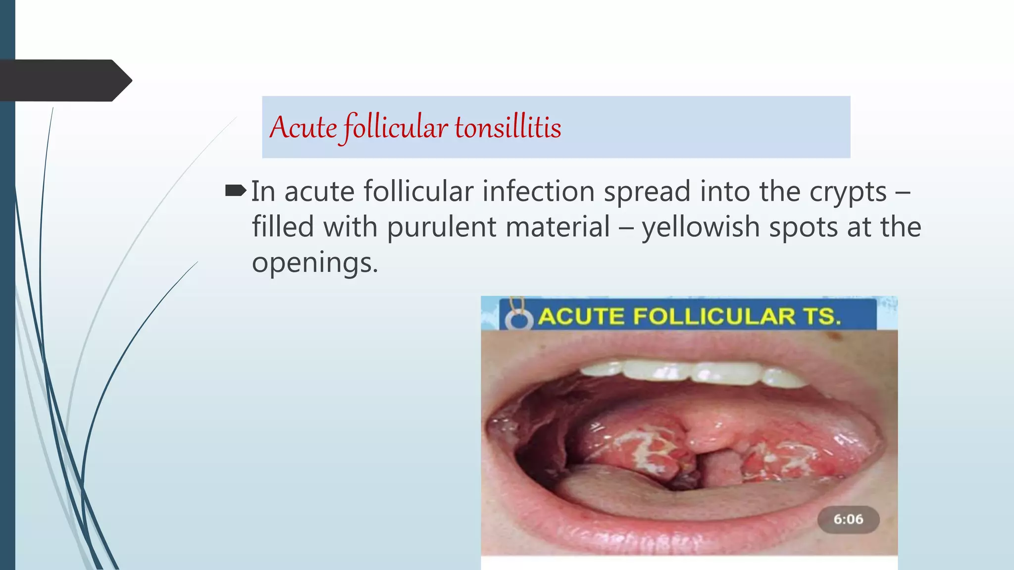 Tonsillitis slideshare for medical students | PPTX