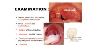 Tonsillitis.pptx