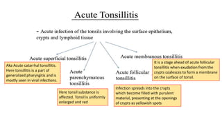 Tonsillitis.pptx | Ear, Nose and Throat Conditions | Diseases and ...
