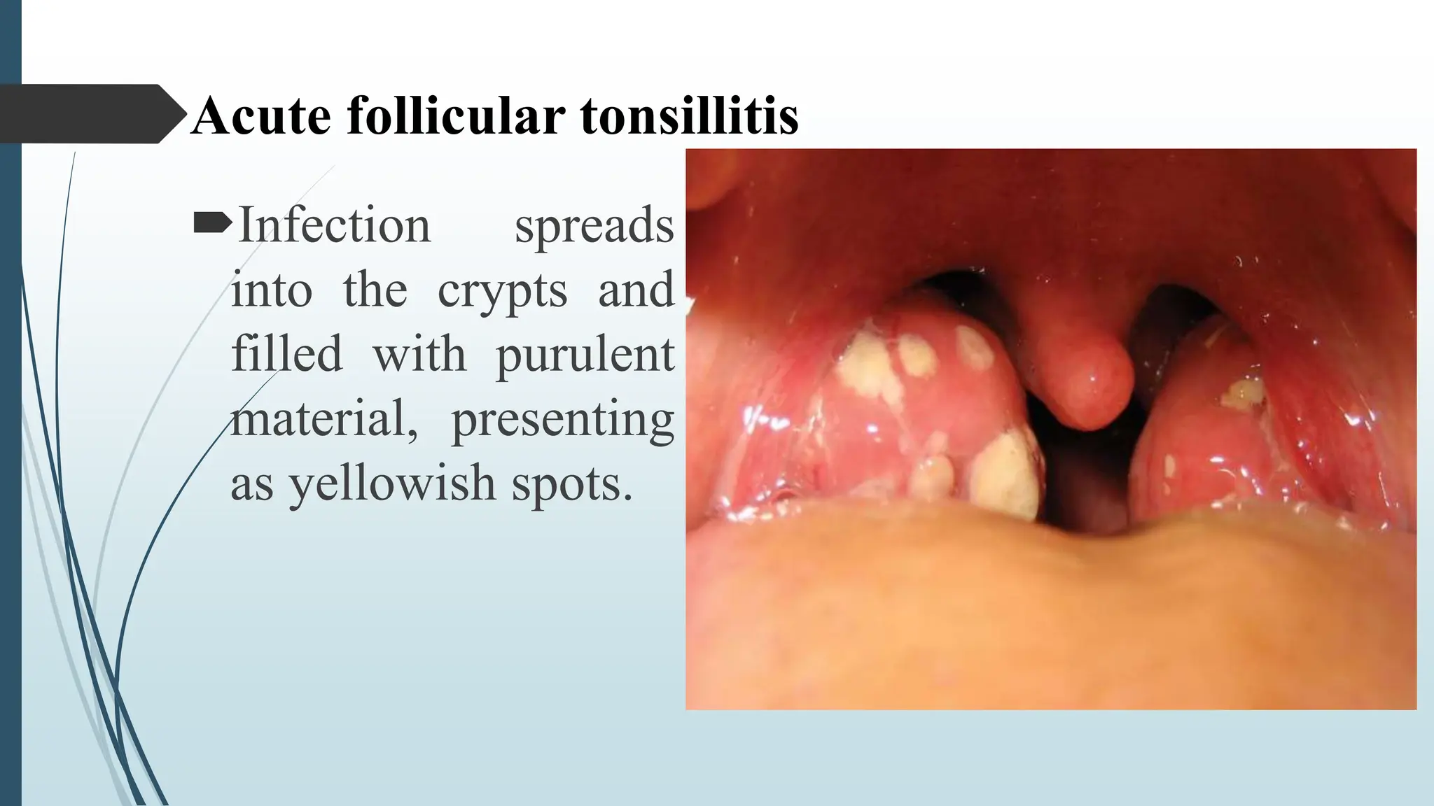 TONSILLITIS in child.pptx,tonsillits, toncelectomy, nursing | PPTX