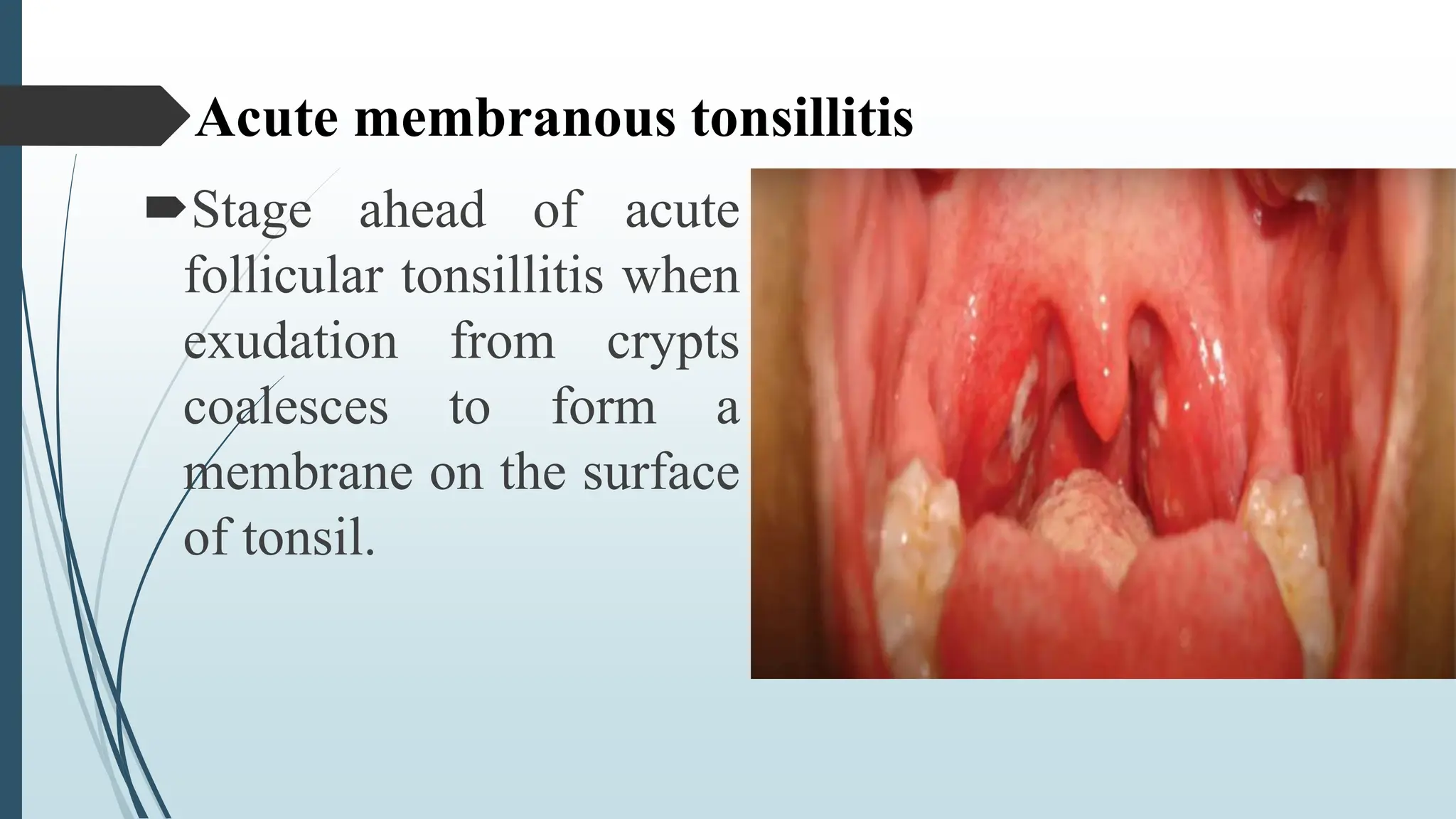 TONSILLITIS in child.pptx,tonsillits, toncelectomy, nursing | PPTX