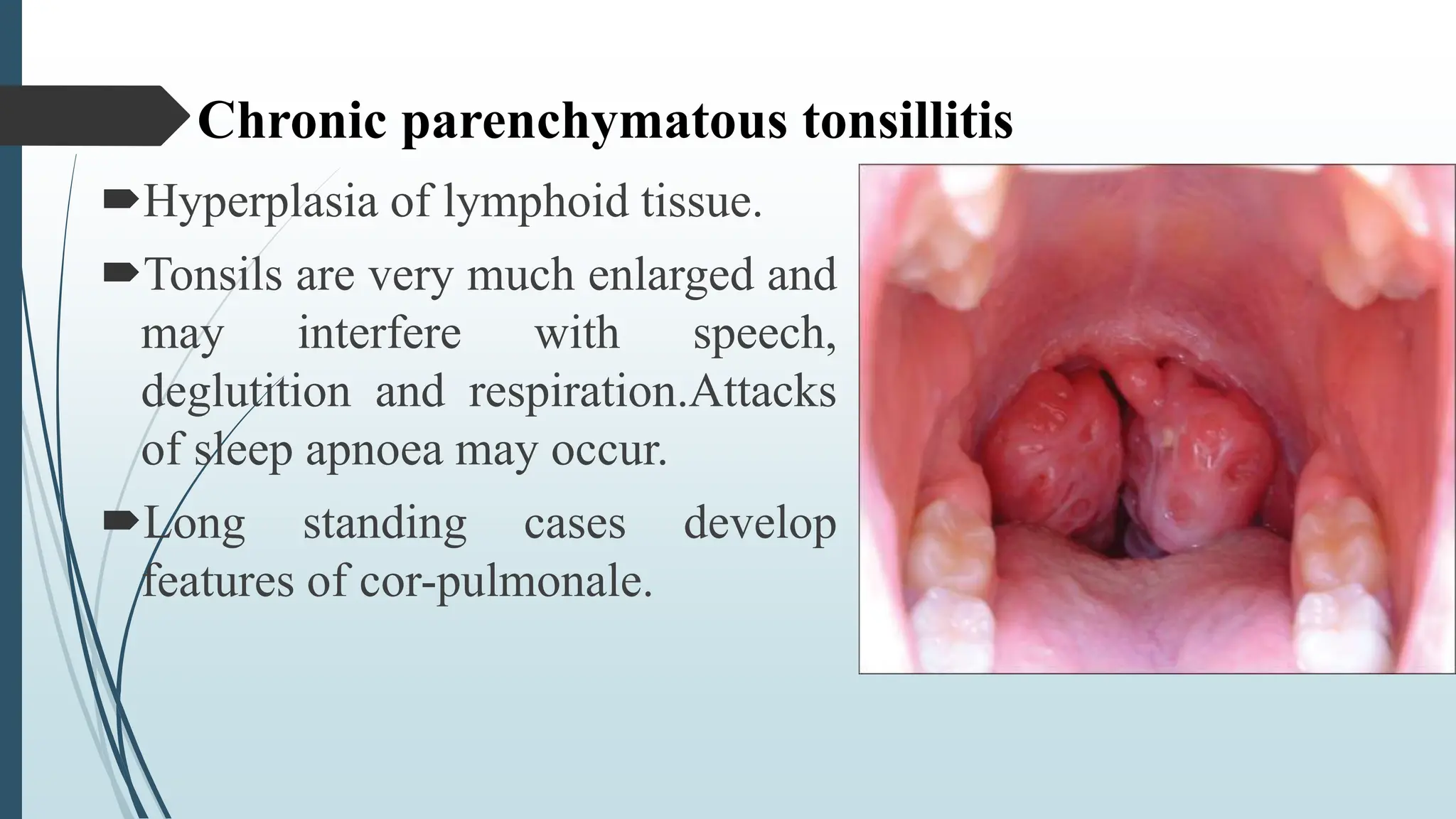 TONSILLITIS in child.pptx,tonsillits, toncelectomy, nursing | PPTX