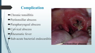 TONSILLITIS in child.pptx,tonsillits, toncelectomy, nursing | PPTX