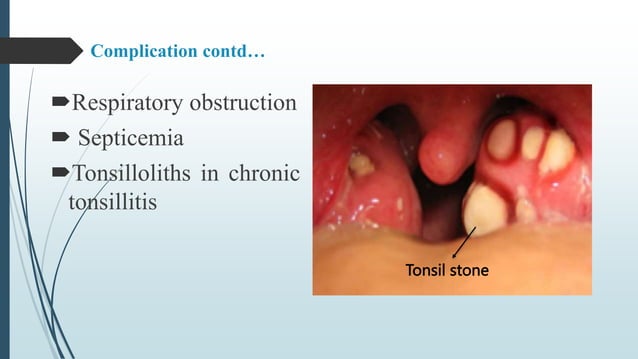 TONSILLITIS in child.pptx,tonsillits, toncelectomy, nursing | PPTX