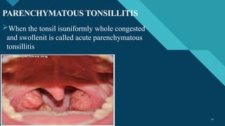 Tonsillitis tonsillitis tonsillitis tonsillitis tonsillitis tonsillitis ...