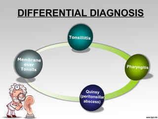 Tonsillitis case | PPT