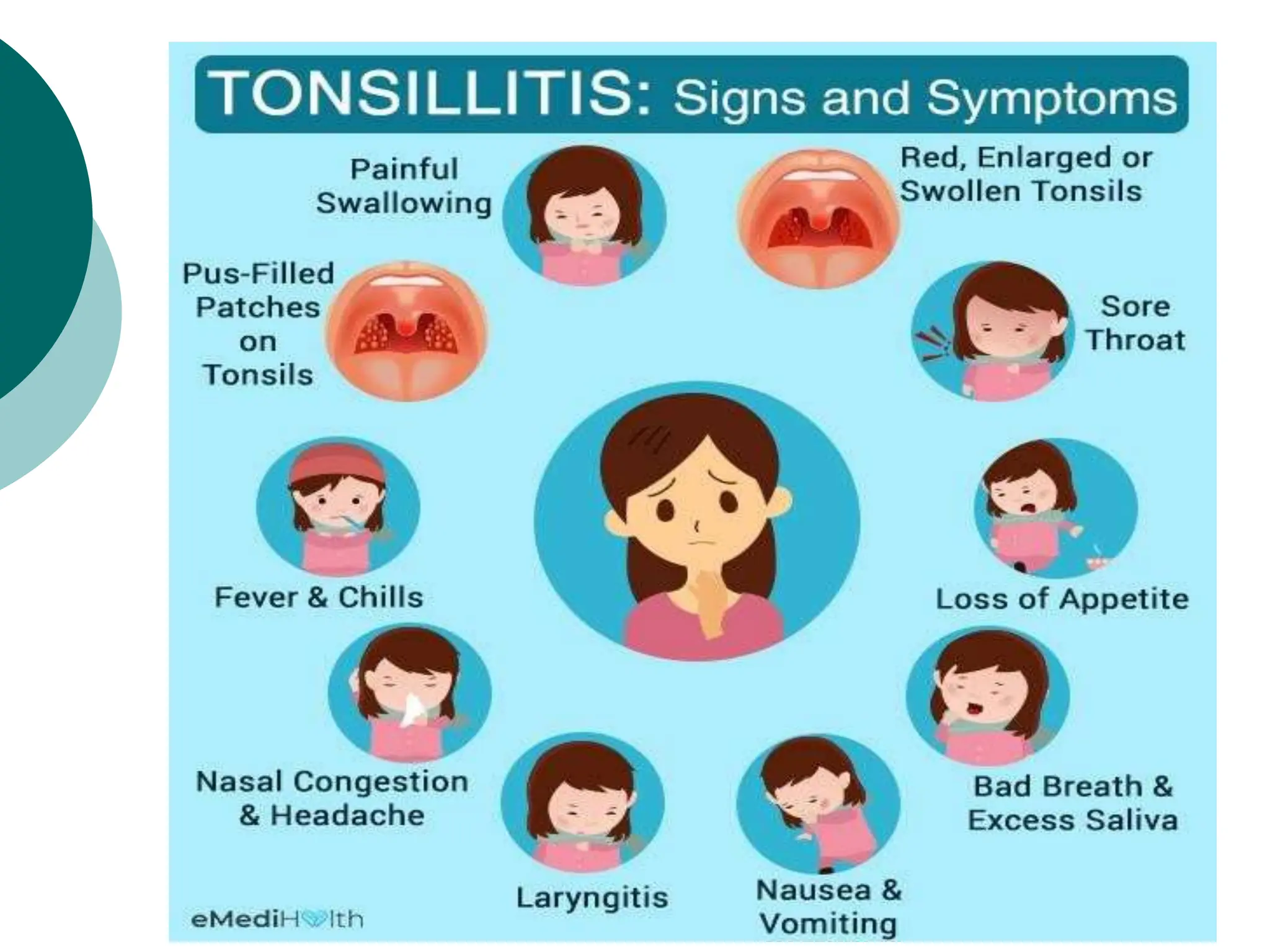 Tonsillitis-ppt.pptx