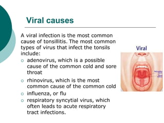 Tonsillitis-ppt.pptx
