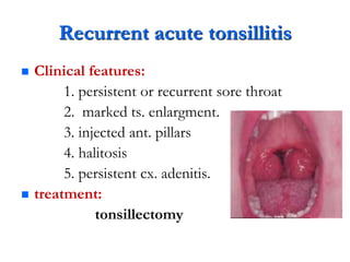 tonsillitis 1.ppt........................ | PPT